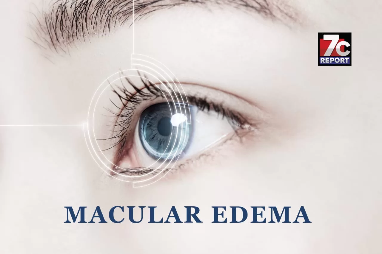 Macular Edema - 7C Report